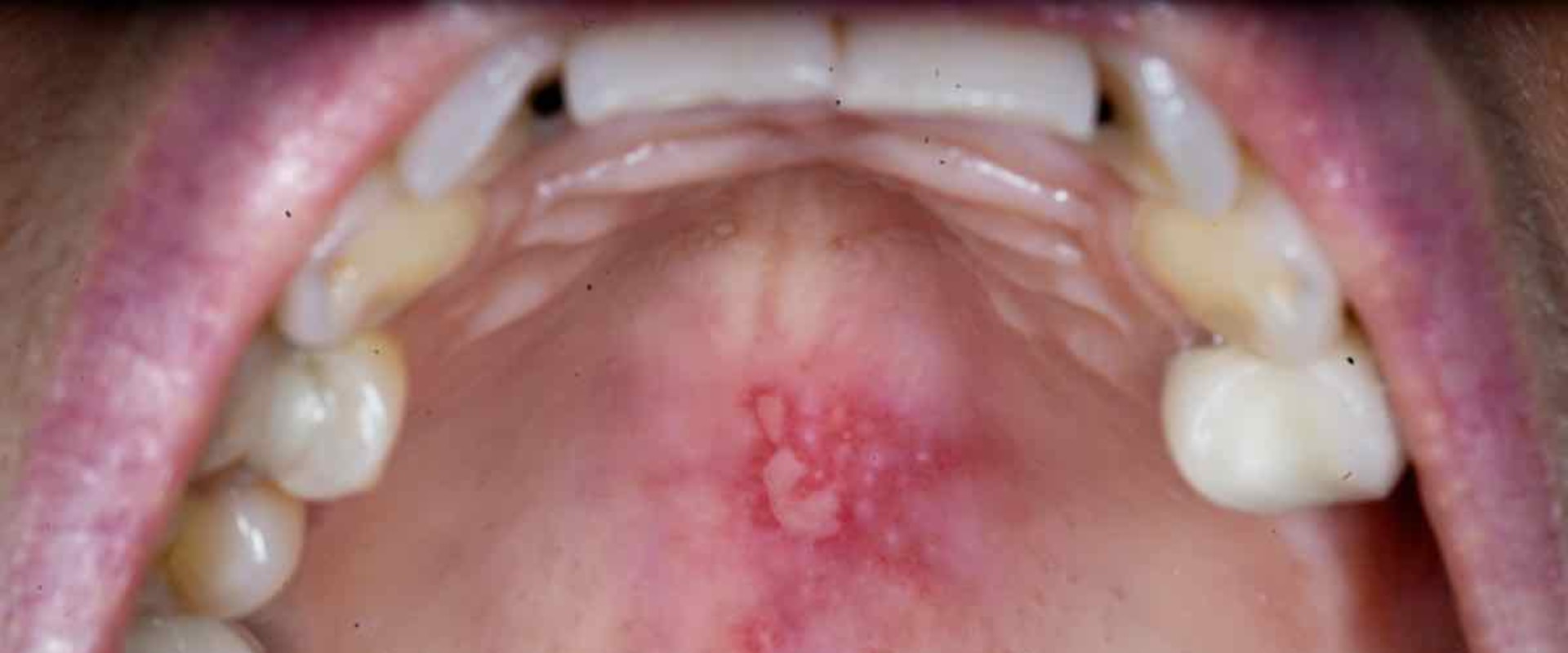 Painful Sores or Blisters in the Mouth: A Comprehensive Overview