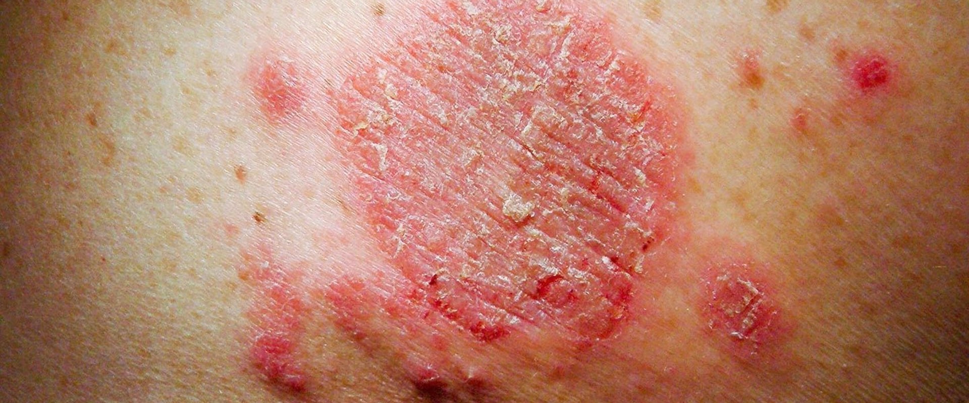Understanding Itchy or Burning Rashes on the Skin