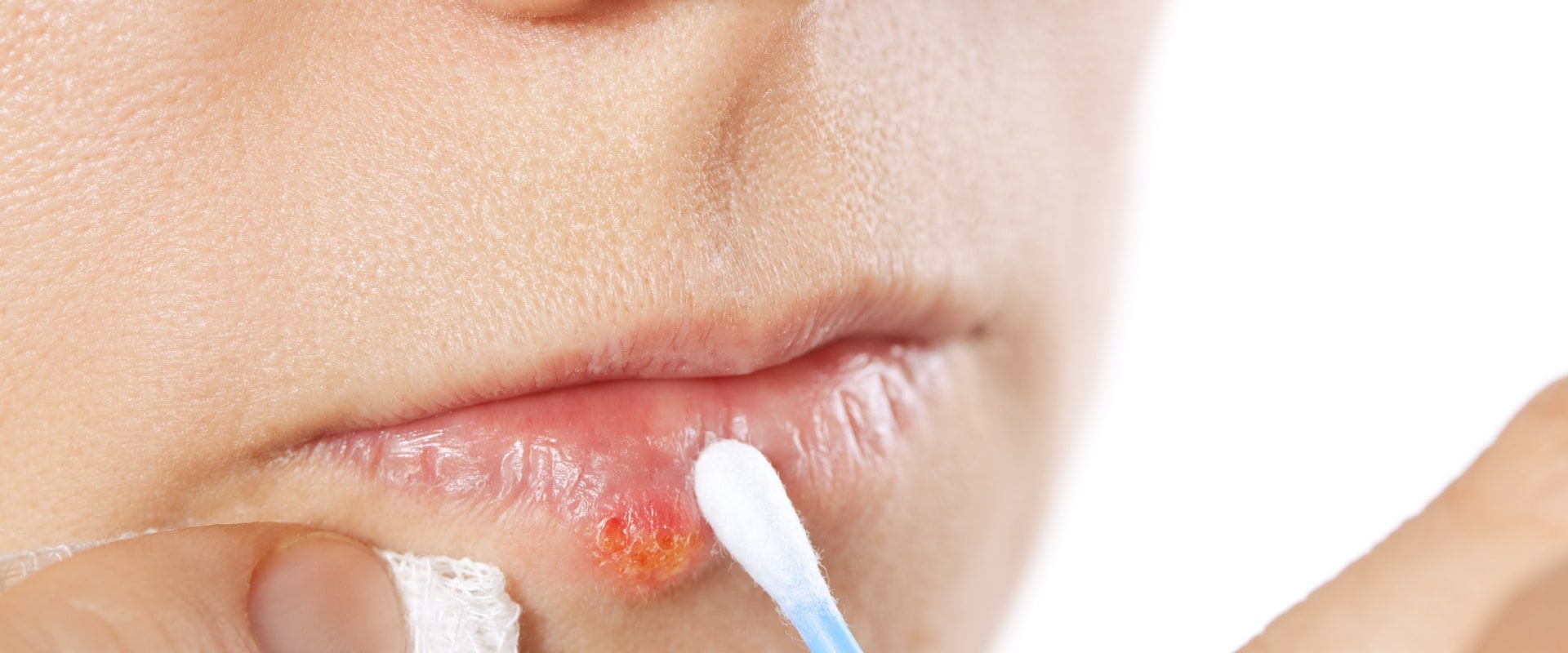 Using Ice Cubes for Cold Compresses: A Home Remedy for Mouth Herpes